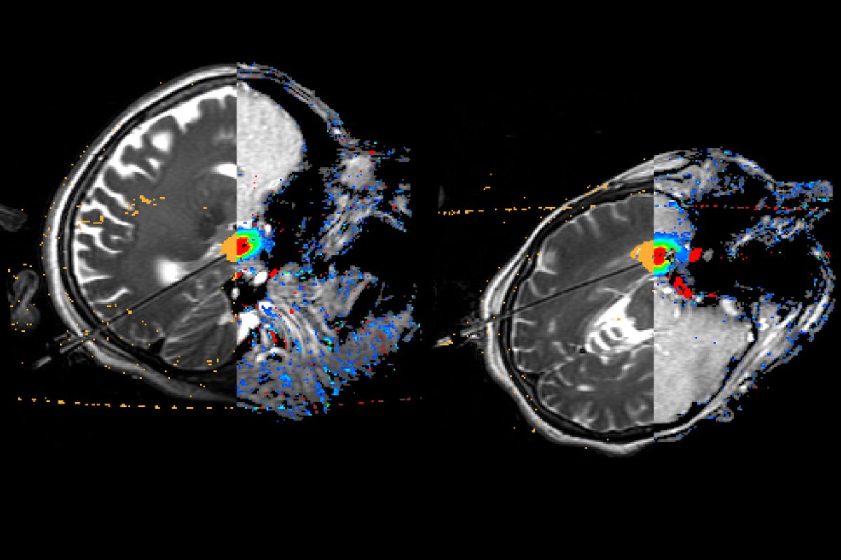 جراحی صرع چیست؟ انواع عمل مغز جهت درمان تشنج مقاوم به درمان